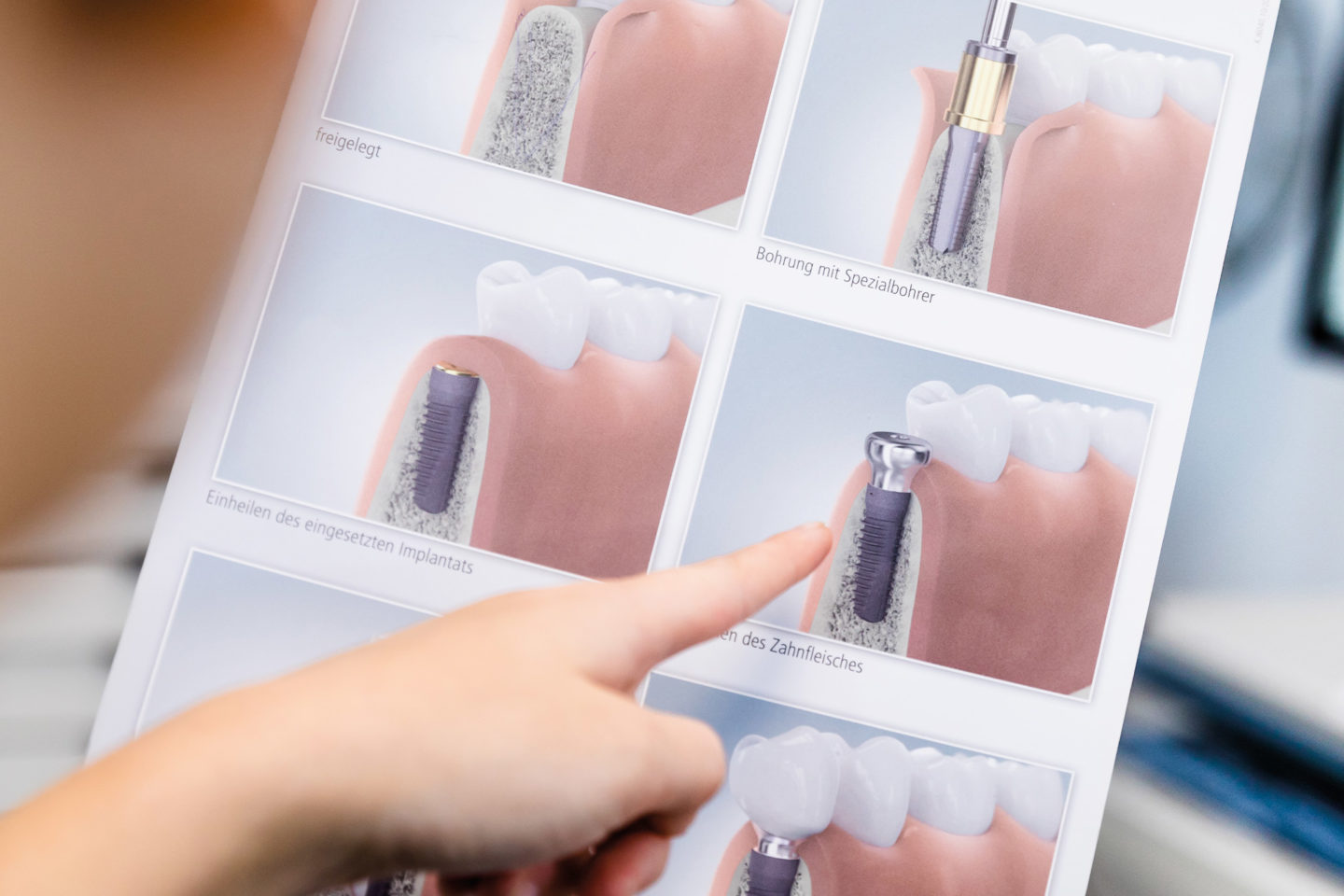 Schritt für Schritt: Der Ablauf einer Implantation - Implantatzentrum ...